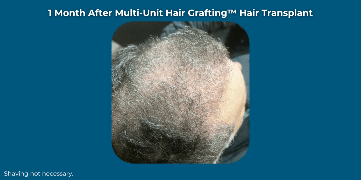 Barry Krauss - Multi-Unit Hair Grafting™ Hair Transplant - We Grow Hair ...