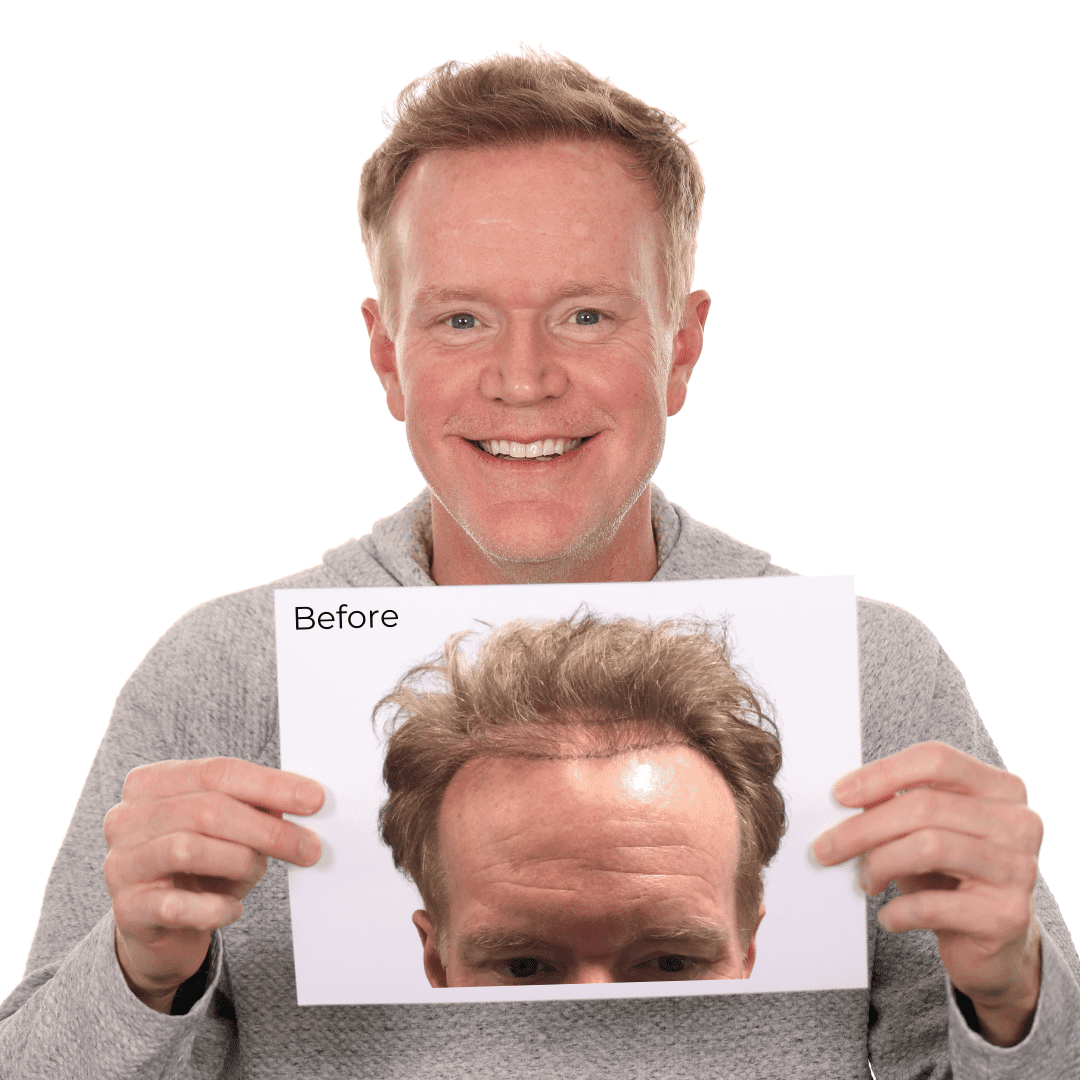 Dave Furst - Multi-Unit Hair Grafting™ - We Grow Hair Indy