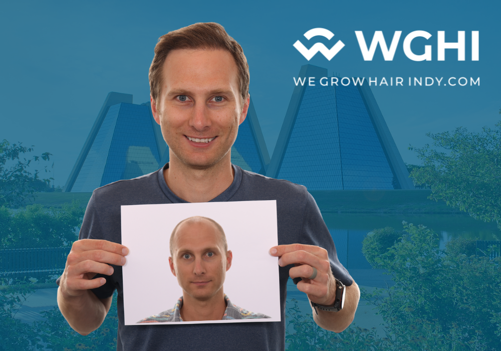 We Grow Hair Indy - Hair Transplant & Hair Restoration Experts