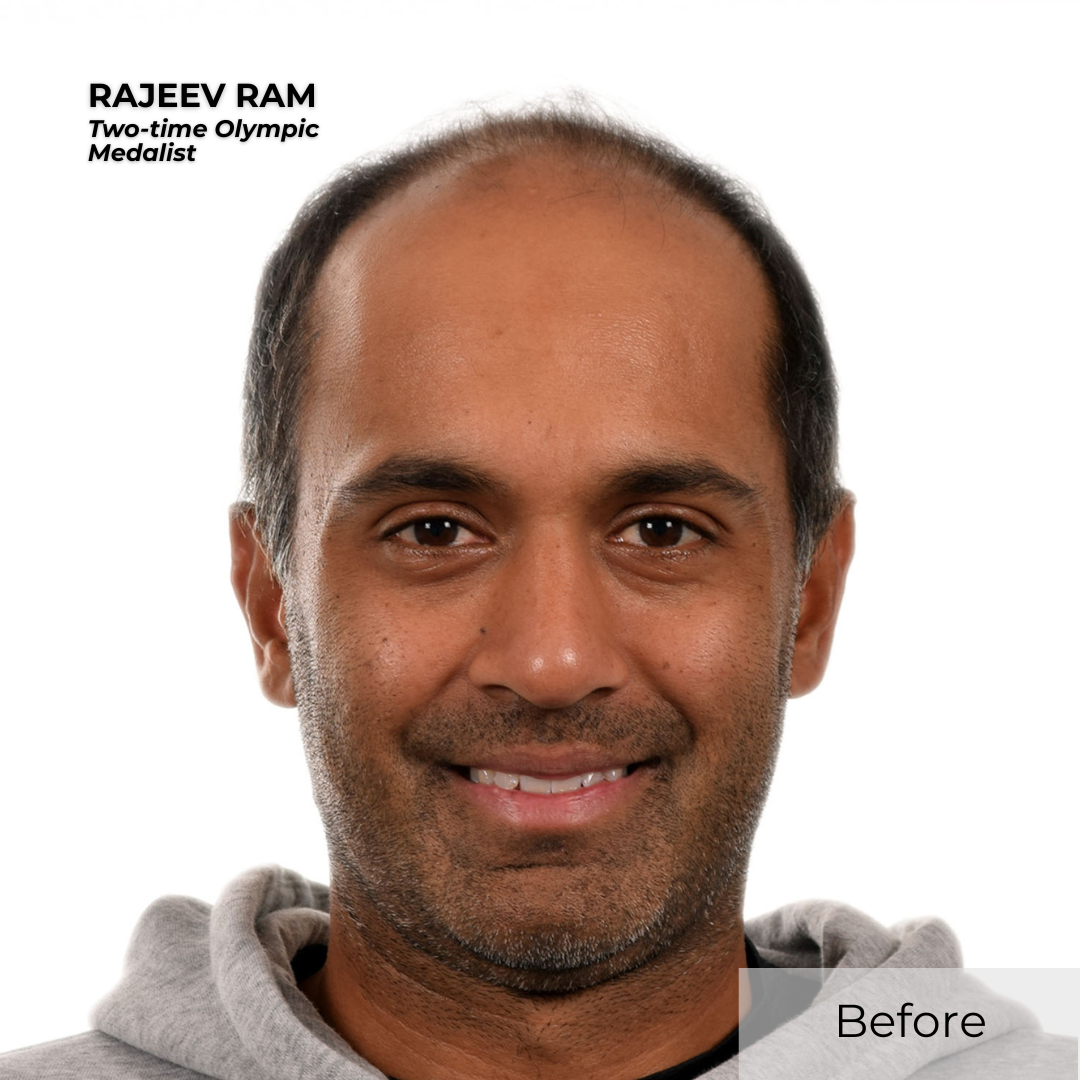 We Grow Hair Indy - Hair Transplant & Hair Restoration Experts