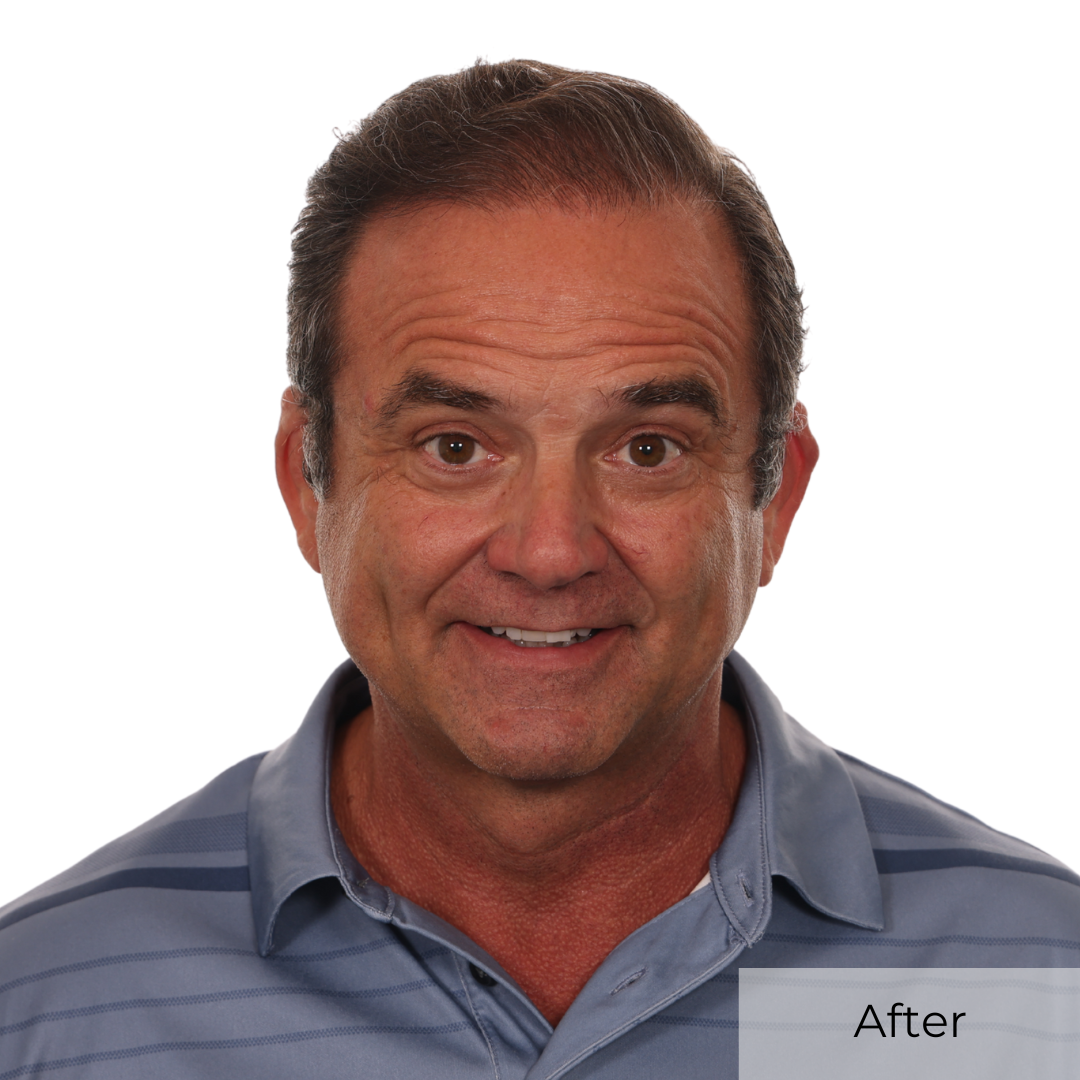 We Grow Hair Indy - Hair Transplant & Hair Restoration Experts